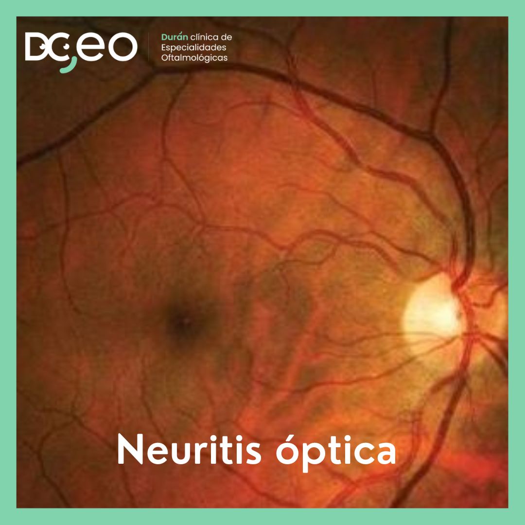 La neuritis óptica • Clínica Oftalmológica DCEO