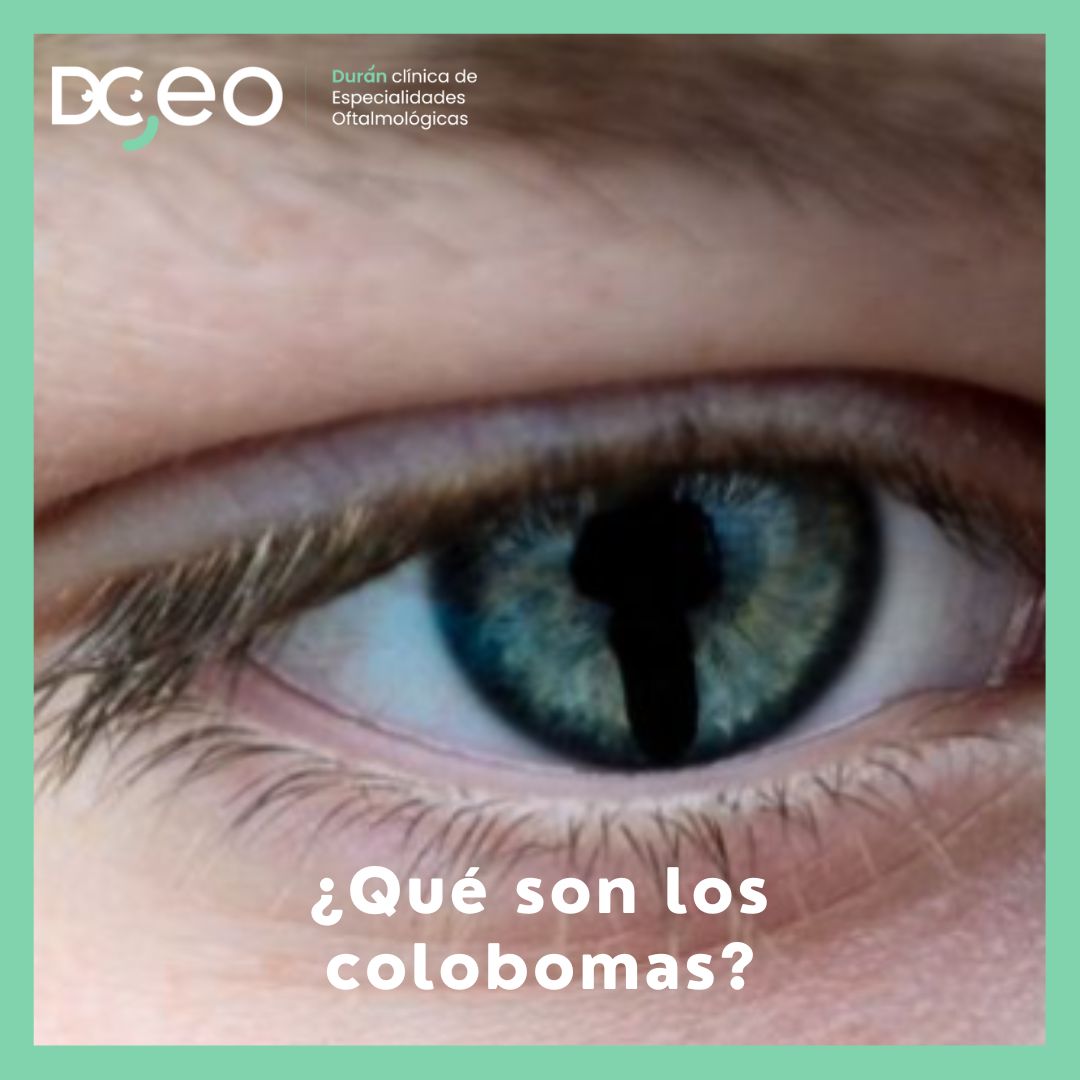 ¿Sabes lo que es un coloboma? • Clínica Oftalmológica DCEO