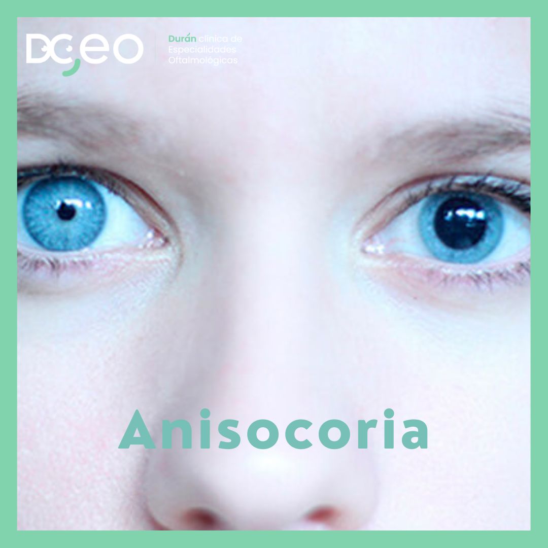 ¿Has conocido a alguien con anisocoria? • Clínica Oftalmológica DCEO