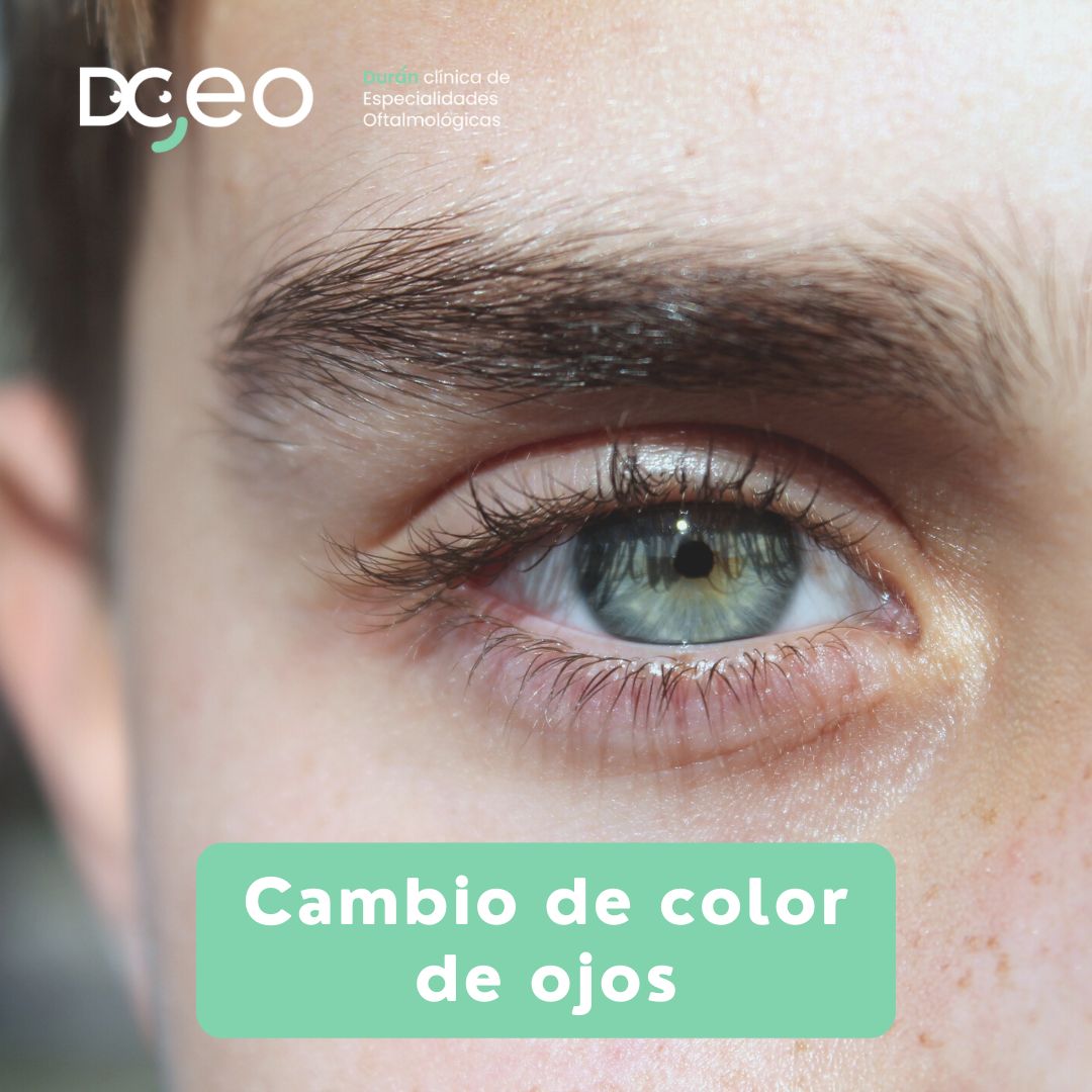 Cambio de color de ojos • Clínica Oftalmológica DCEO